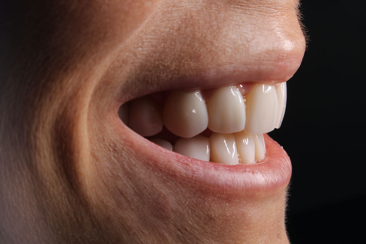 Pyorrhea (or periodontitis): Symptoms, Prevention, and Treatments
